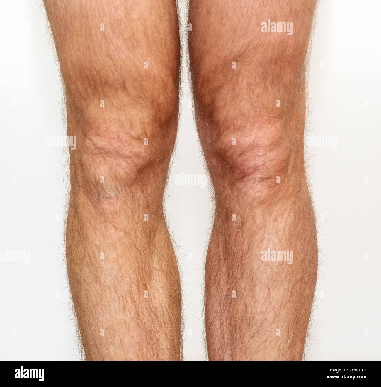 Front View Of Male Knees With Osgood Schlatter Disease Right Leg After