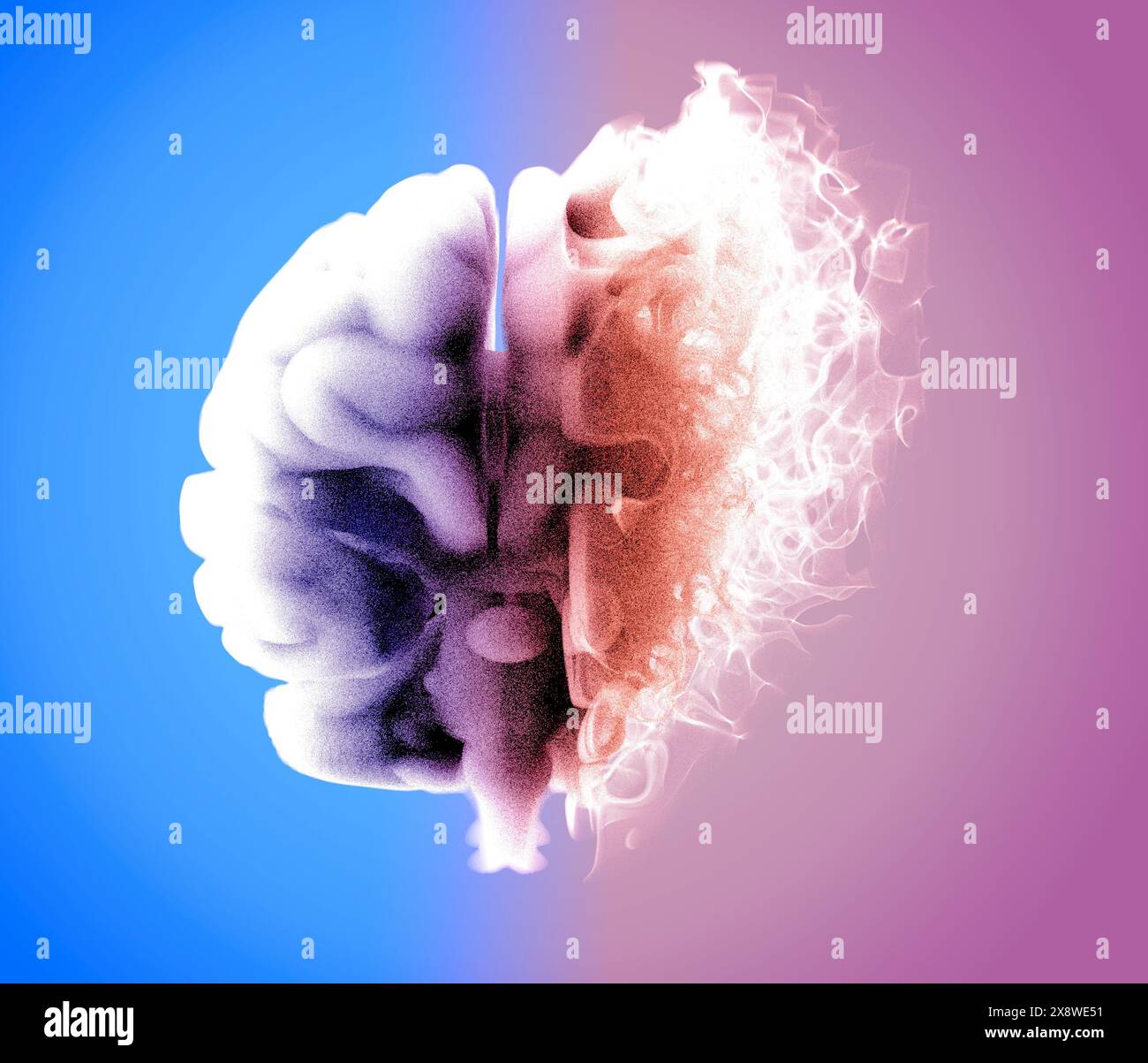 Brain seen from the front. Degenerative disease. Brain degenerative ...