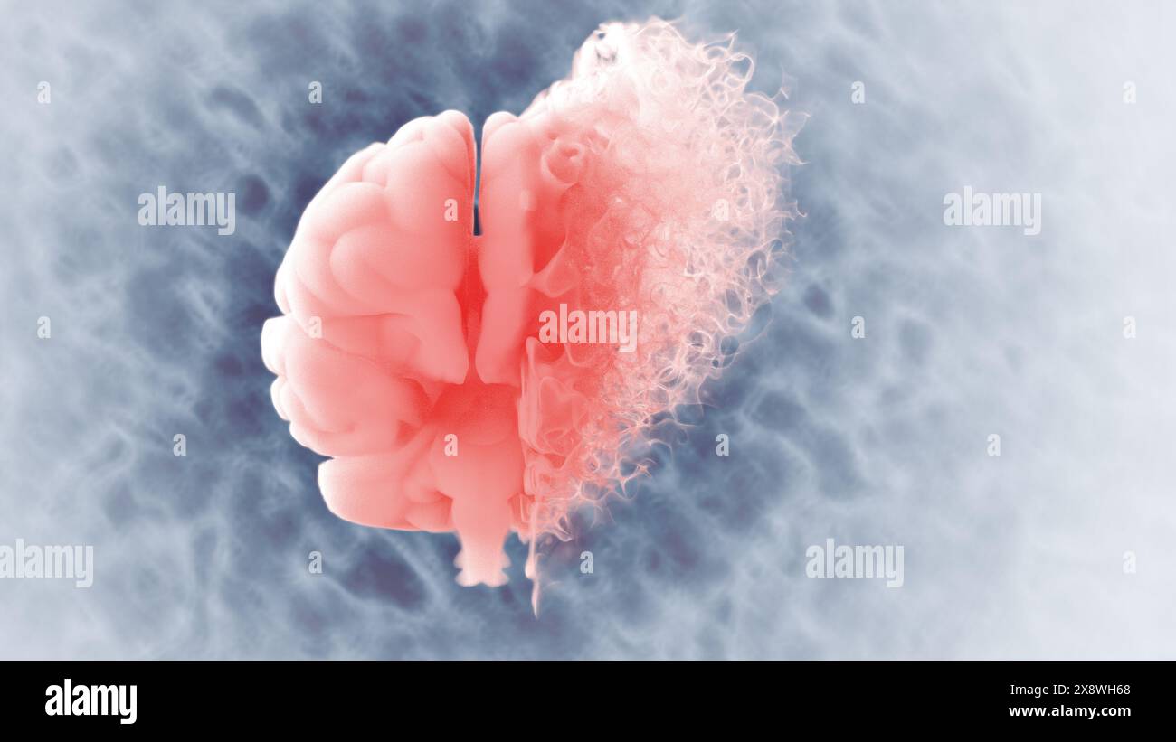 Brain seen from the front. Degenerative disease. Brain degenerative ...