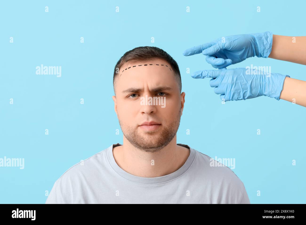 Doctor pointing at marks on young man's forehead with hair loss problem ...