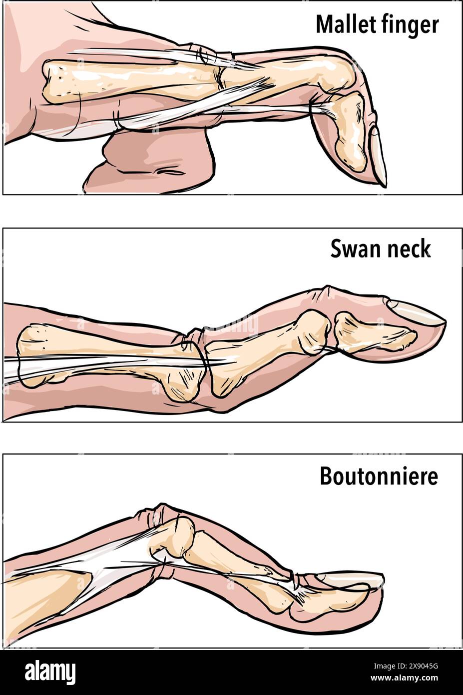 Common Finger Injuries vector illustration Stock Vector Image & Art - Alamy