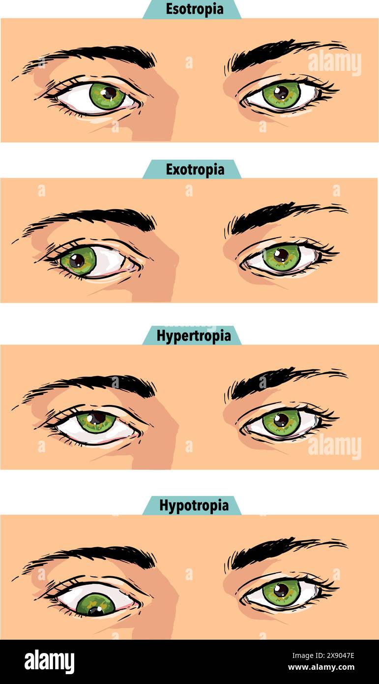 Vector illustration of a Strabismus or Crossed Eyes Vector illustration ...