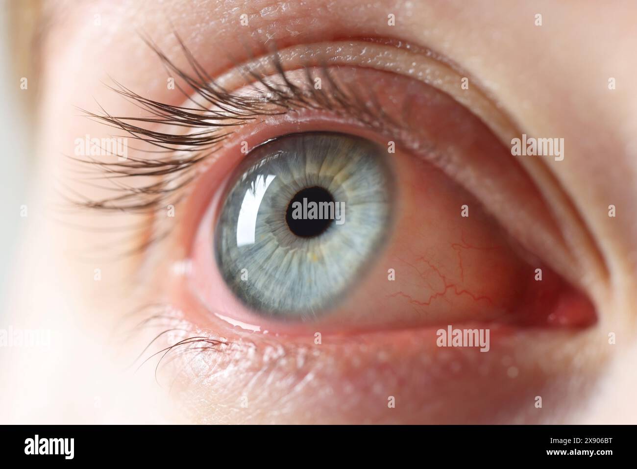 Woman with red eye suffering from conjunctivitis, closeup Stock Photo ...
