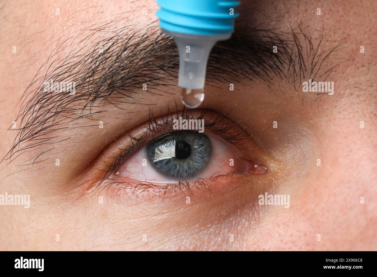Man with conjunctivitis using eye drops, closeup Stock Photo - Alamy