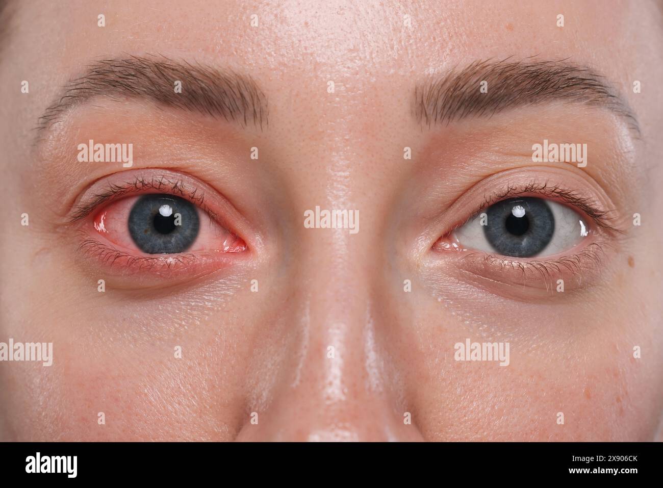 Conjunctivitis and adult hi-res stock photography and images - Alamy