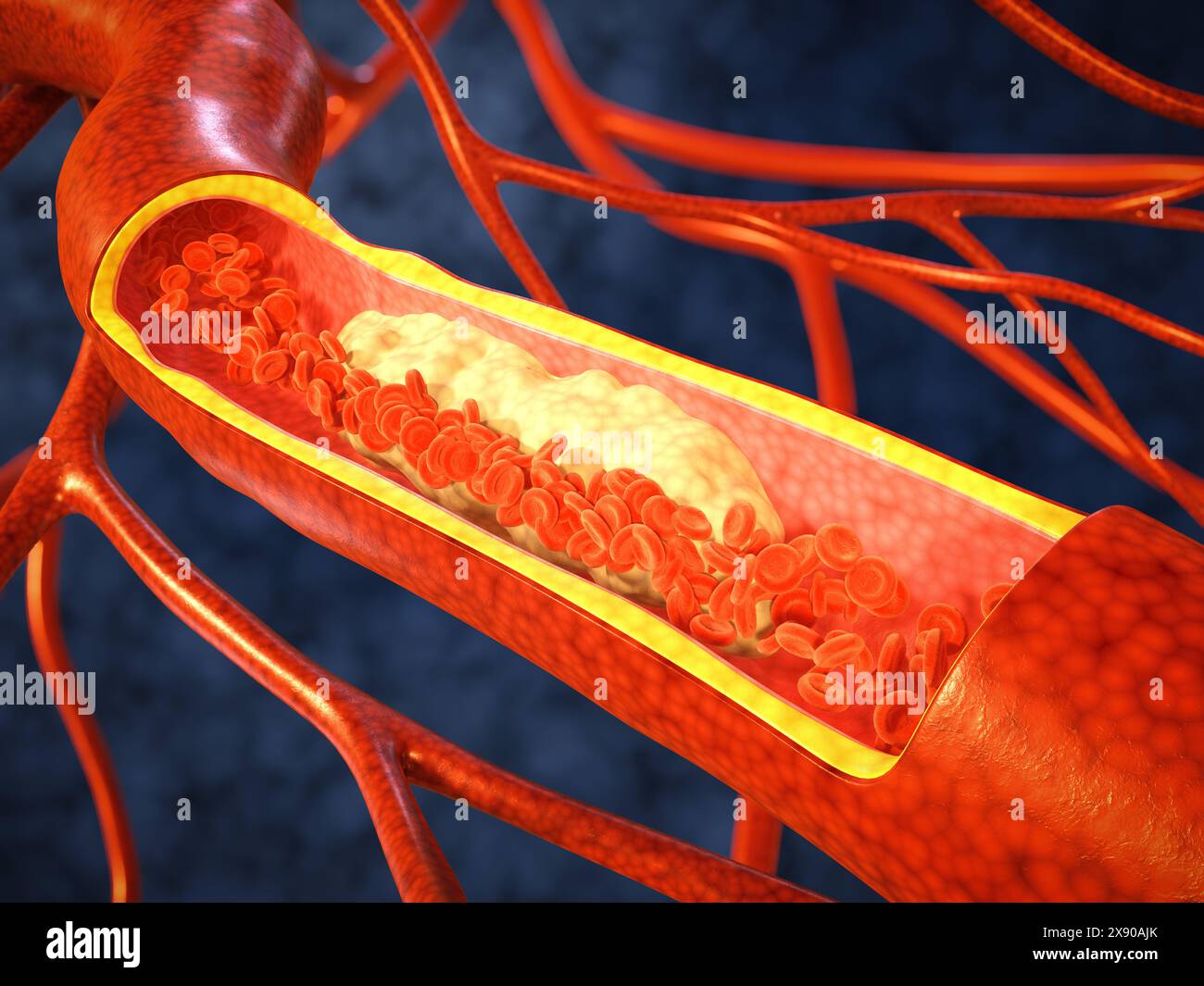 Flow of red blood cells in a blood vessel close-up. A cholesterol ...