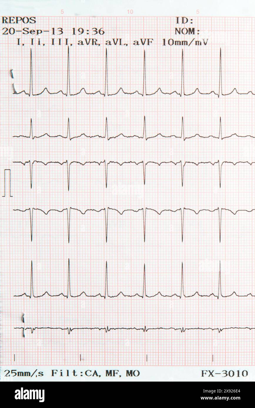 Electrocardiogram, human heart. Ecg 013843 006 Stock Photo - Alamy