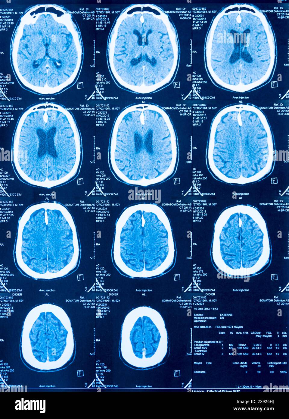 Tomography of the brain obtained by scanner. Brain scan 013843 021 ...