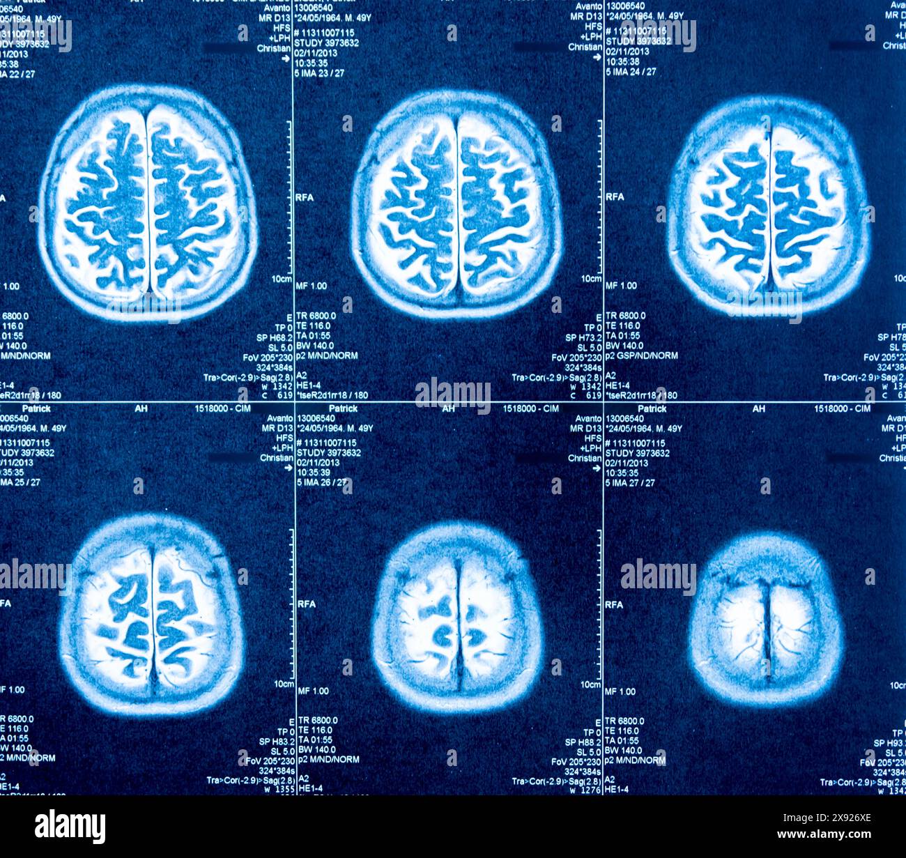 Tomography of the brain obtained by scanner. Brain scan 013843 032 ...