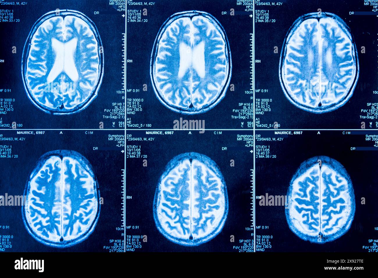 Tomography of the brain obtained by scanner. Brain scan 013843 037 ...
