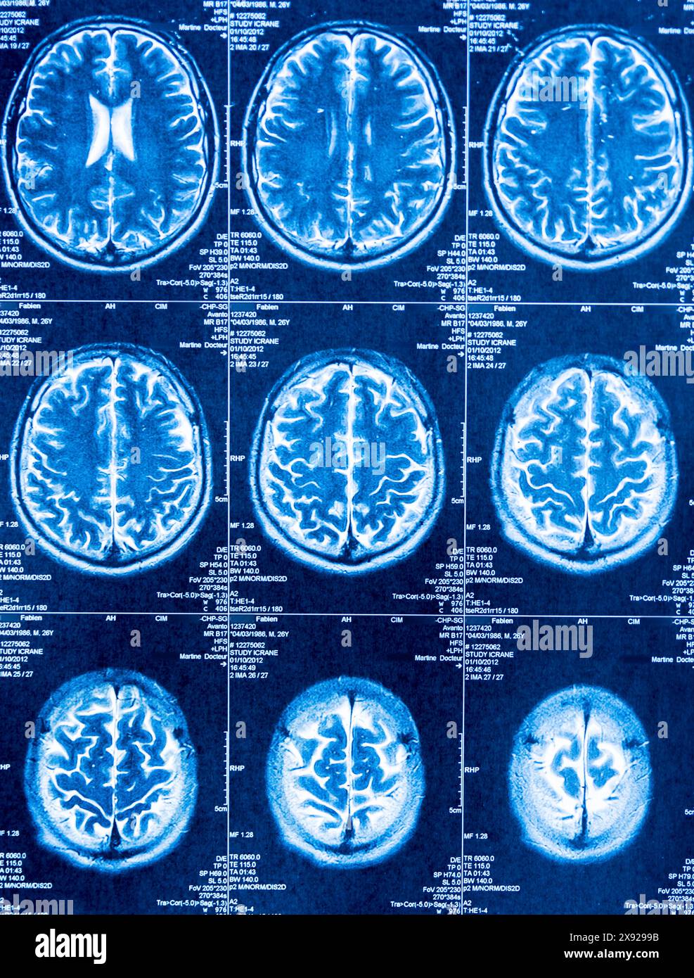 Tomography of the brain obtained by scanner. Brain scan 013843 028 ...
