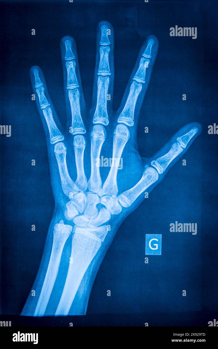 Normal left hand radiograph. Hand radio 013843 017 Stock Photo - Alamy