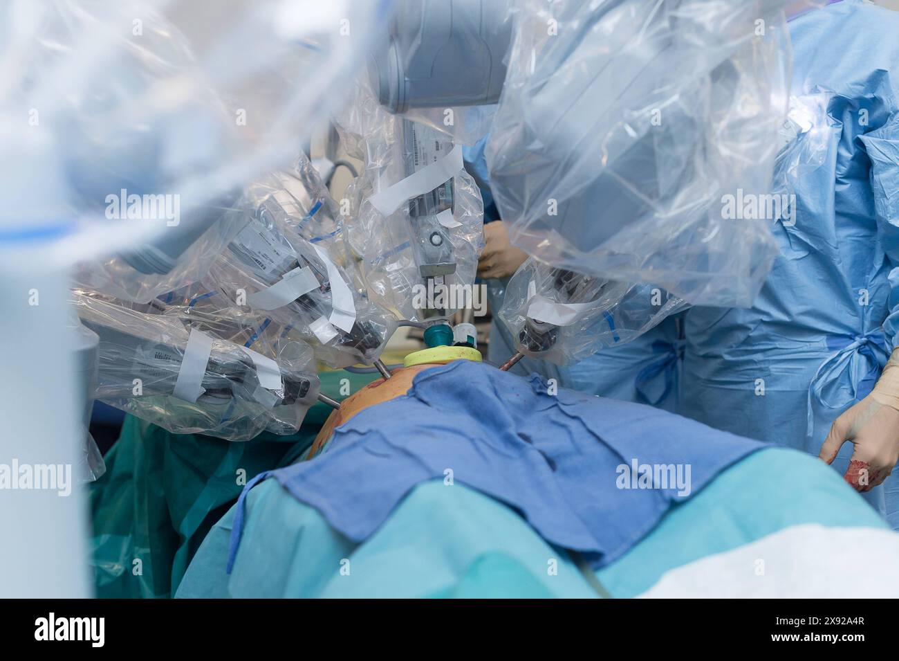 Report at Nice University Hospital, Pasteur Hospital, for a radical ...