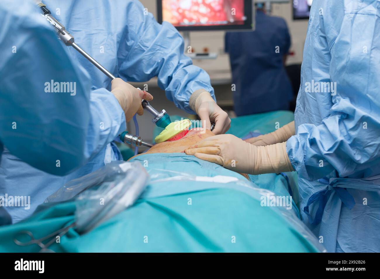 Report at Nice University Hospital, Pasteur Hospital, for a radical ...