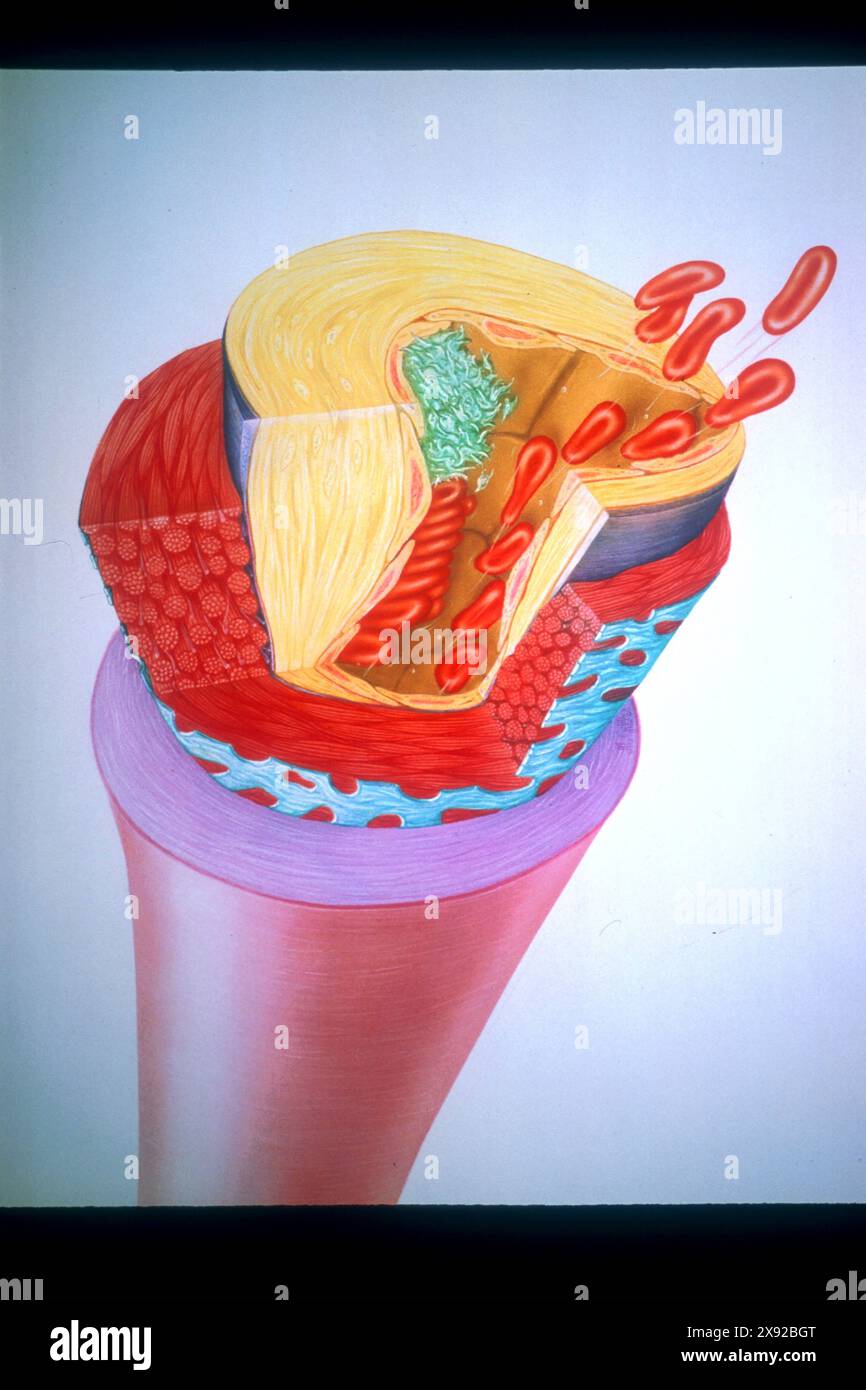 Formation of blood clot in a vessel obstructs the artery or vein and ...