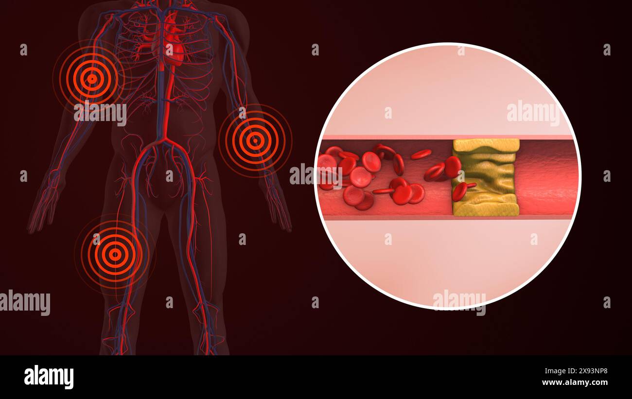 Peripheral neuropathy of the feet hi-res stock photography and images ...
