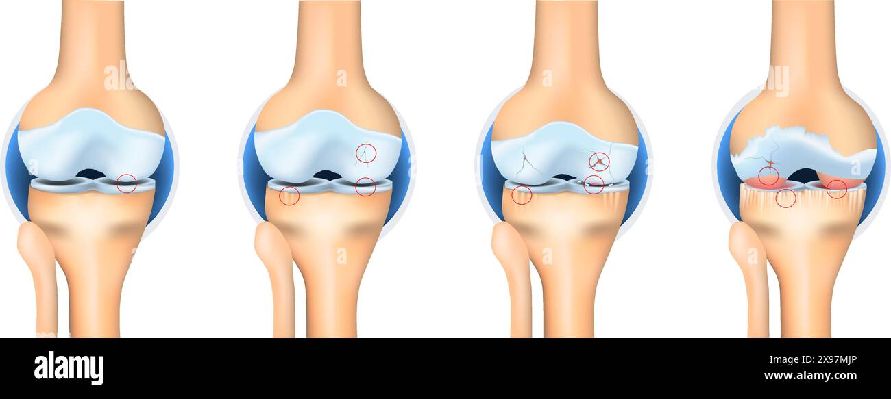 Stages of Osteoarthritis. knee joint anatomy Vector illustration Stock ...