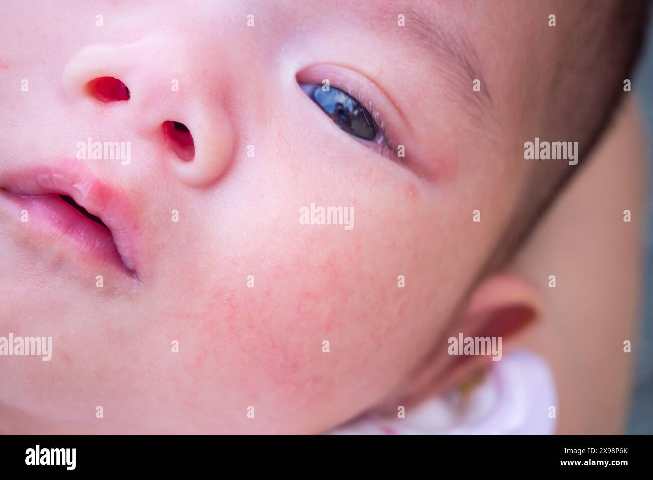 newborn baby with dermatitis allergy on face Stock Photo - Alamy