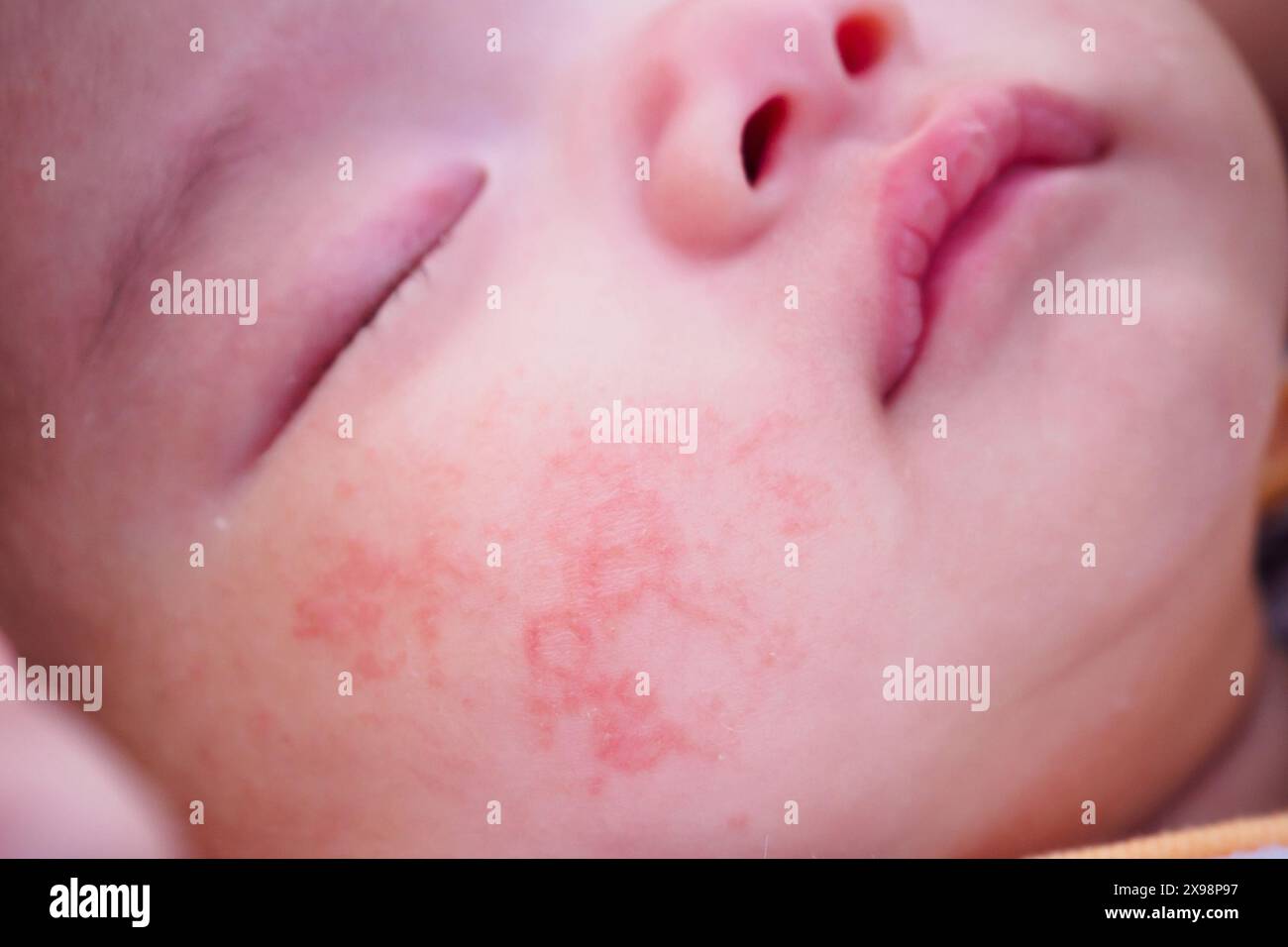 newborn baby with dermatitis allergy on face Stock Photo - Alamy