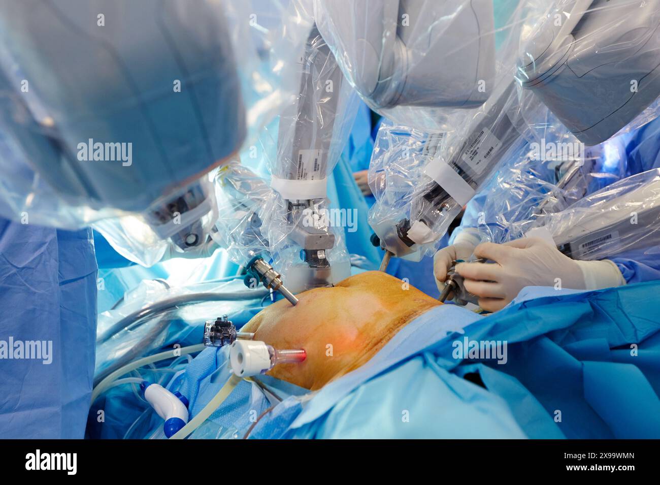 Operating room, Prostate cancer robotic surgery, Da Vinci surgical robot, Urology, Hospital ...