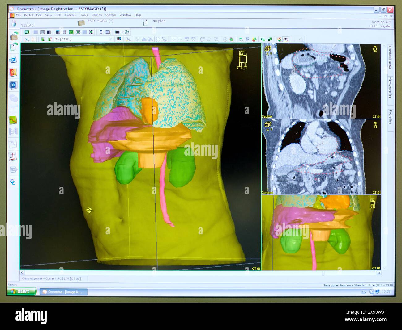 Imrt Intensity Modulated Radiation Therapy Abdomen Cancer 3d Radiotherapy Treatment Planning