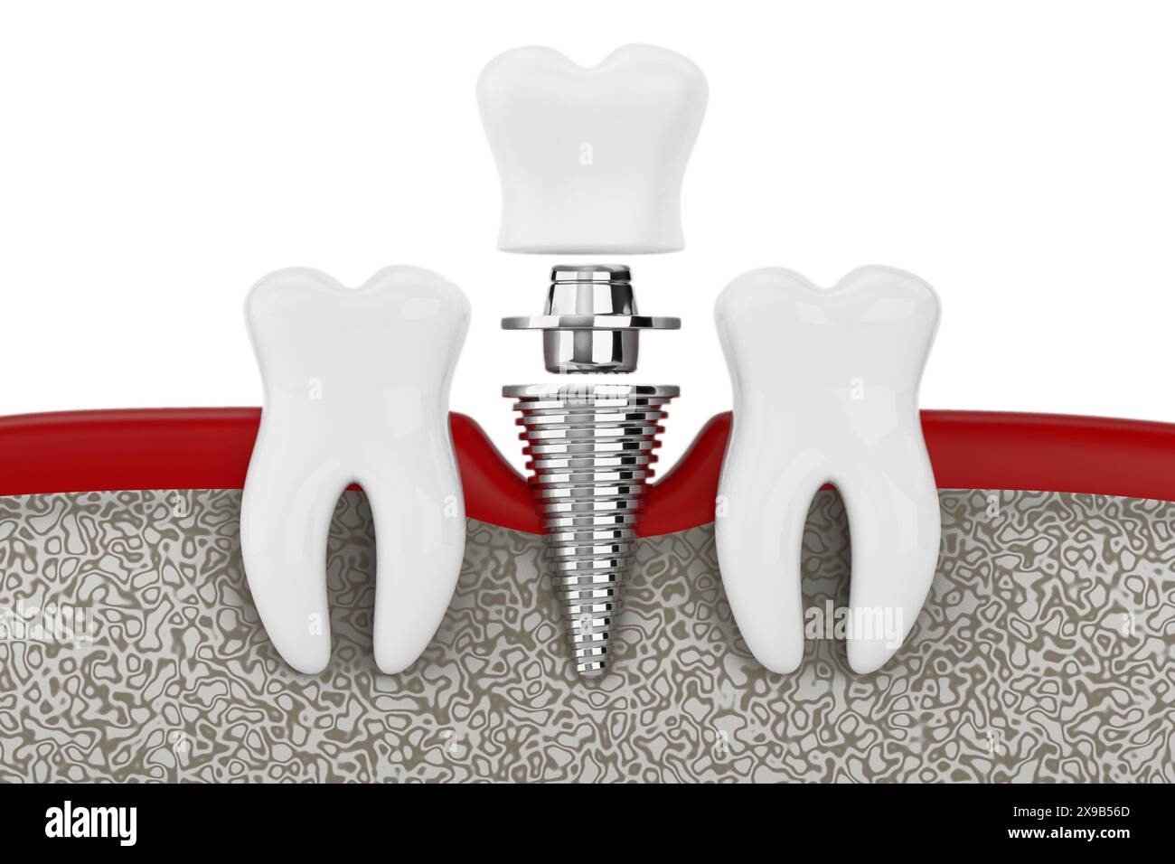 Dental Tooth Implant Installation and Crown Placement on a White ...
