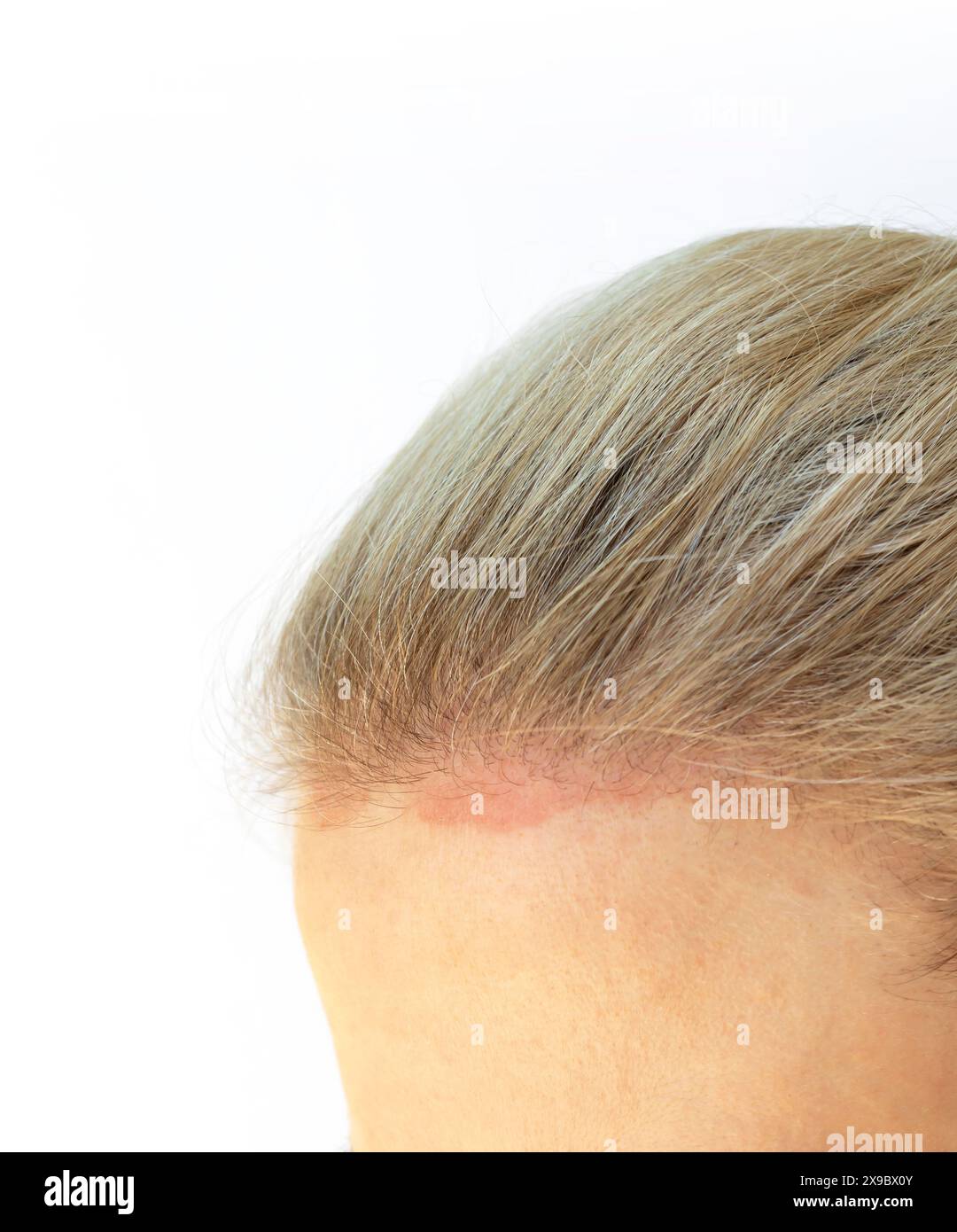 Closeup Cropped Caucasian Female Face with Sunburn Skin On Scalp ...