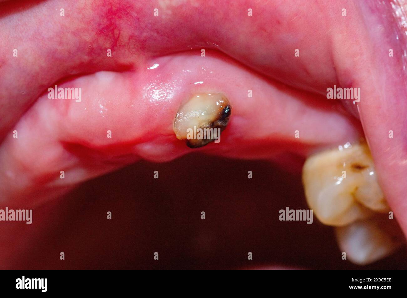 Macro photo of tooth root with caries in human gums Stock Photo - Alamy