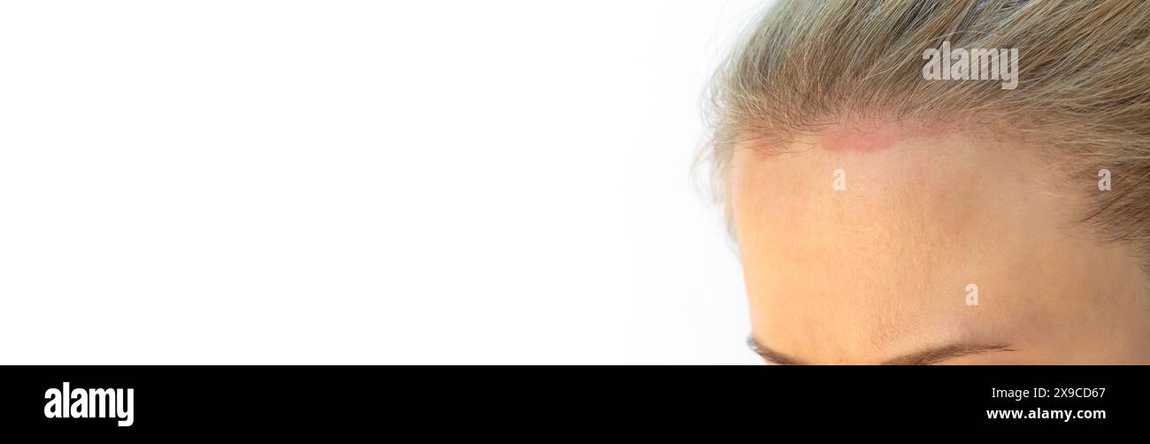 Banner Cropped Caucasian Female Face with Sunburn Skin On Scalp ...