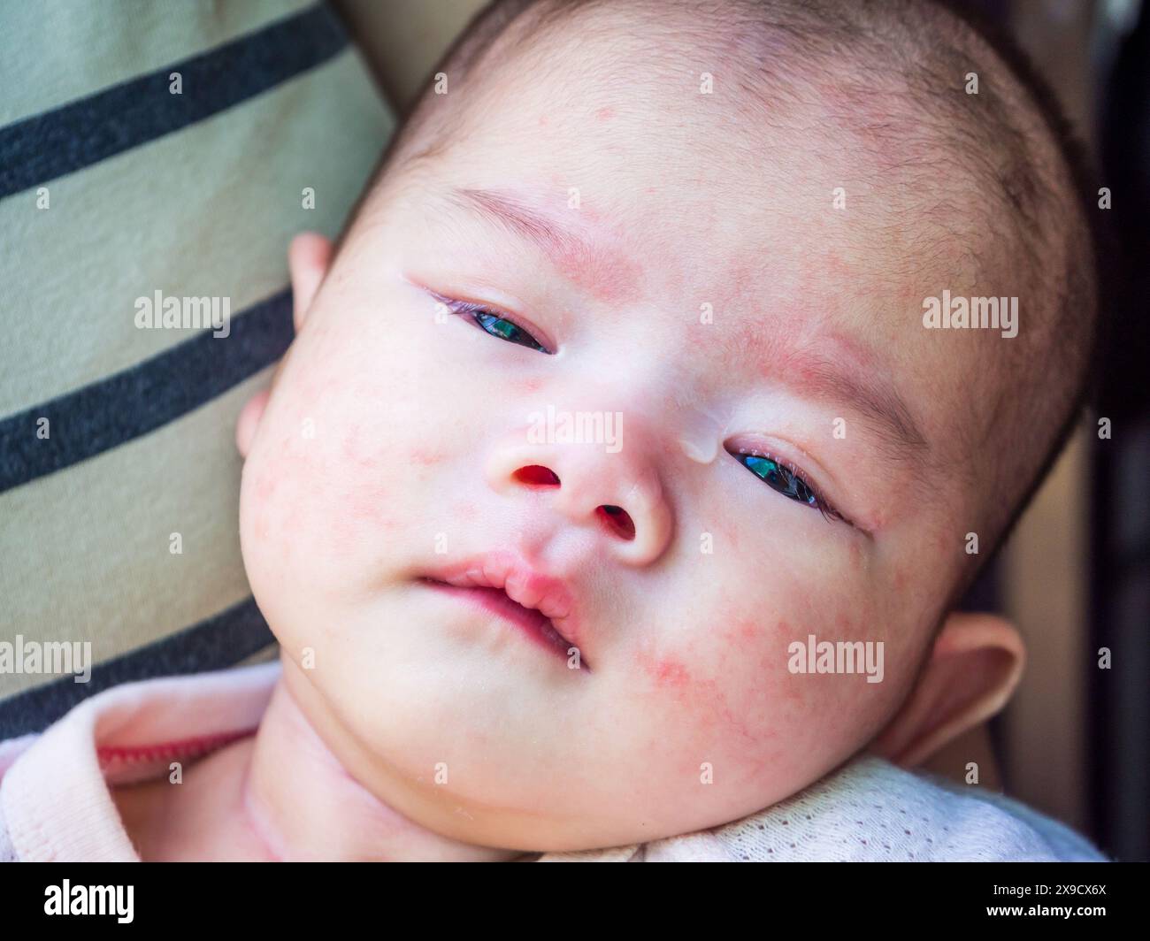 newborn baby with dermatitis allergy on face Stock Photo - Alamy