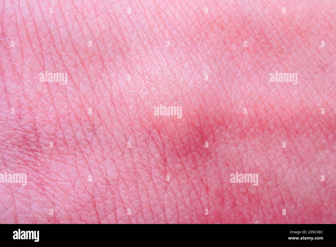 skin allergy with rash after mosquito bite Stock Photo - Alamy