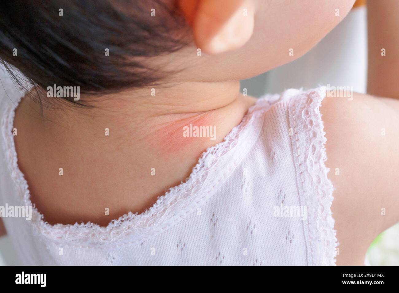 baby skin rash and allergy with red spot cause by mosquito bite at neck ...
