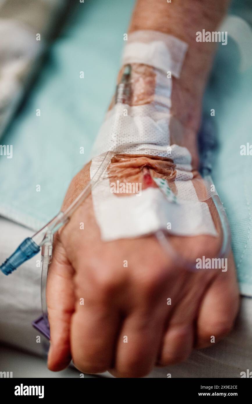 Close up of intravenous lines in an elderly cancer patient's hand Stock ...