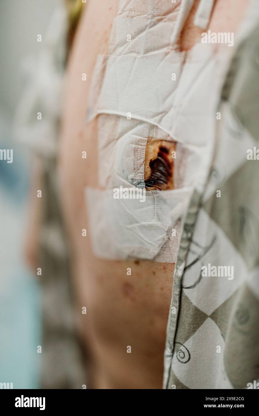 close up of wound on the back of elderly patient in a hospital Stock ...