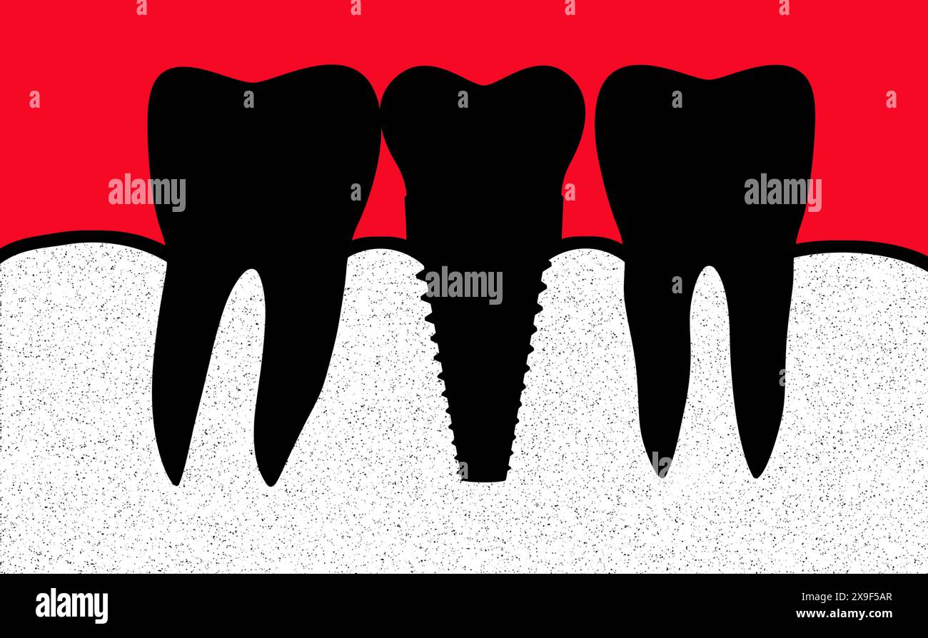 A dental implant, an implanted tooth is seen between two normal teeth ...