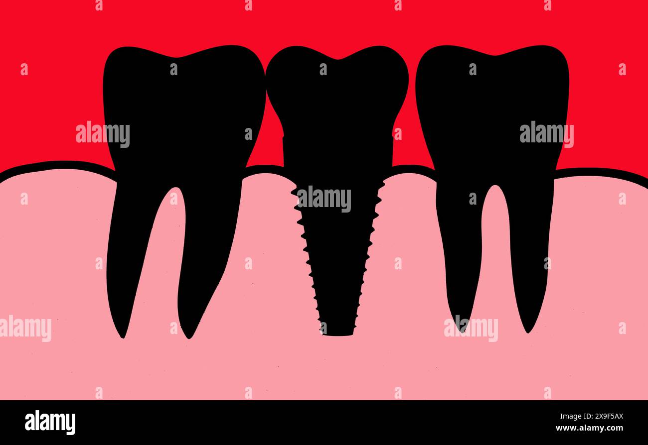A dental implant, an implanted tooth is seen between two normal teeth ...