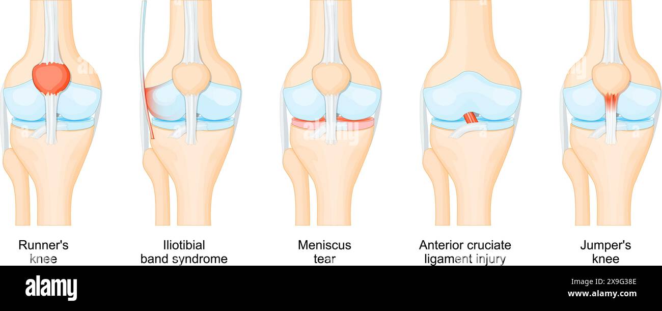 Knee injuries. Anatomy of human knee joint. Anterior cruciate ligament injury, Jumper's and ...