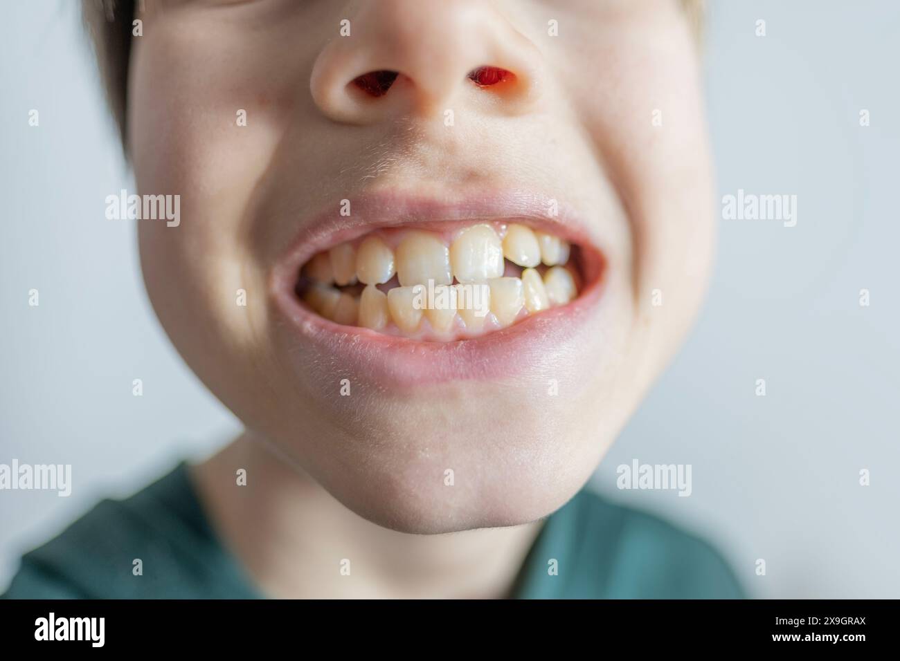 teenager 12 years old shows tooth sways and hurts, concept pediatric ...