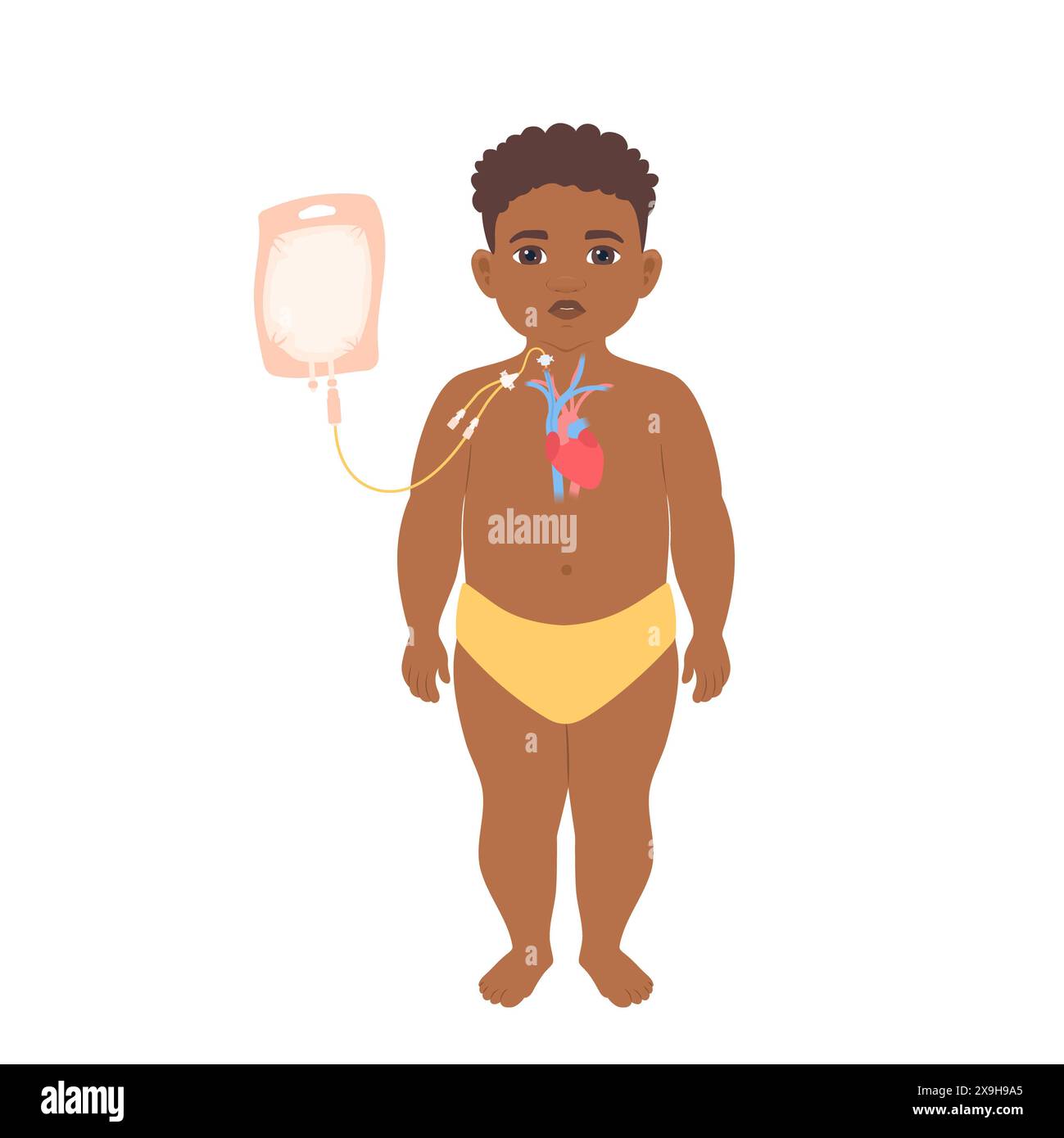Illustration showing a child receiving parenteral nutrition through a ...