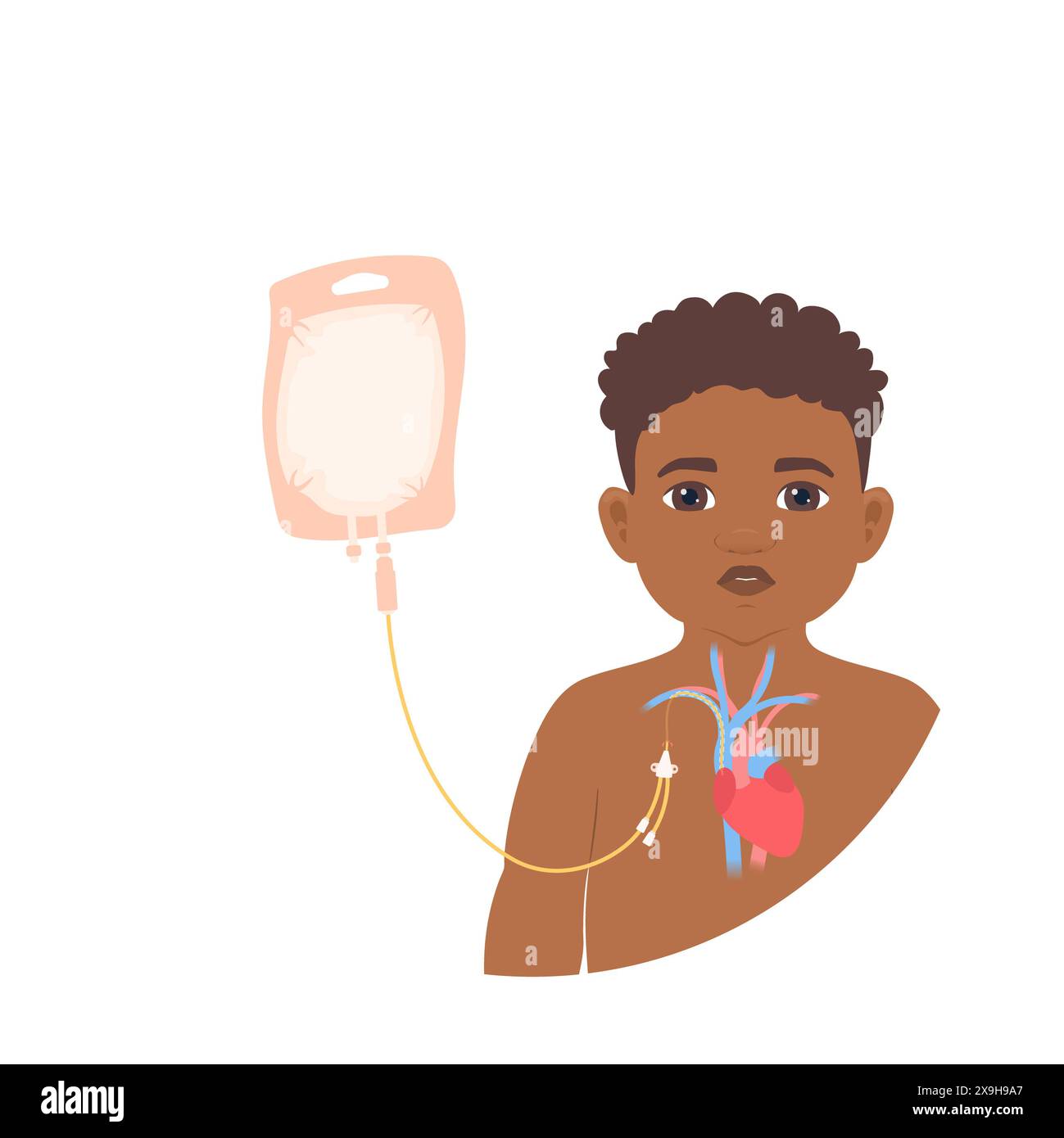 Illustration showing a child receiving parenteral nutrition through a ...