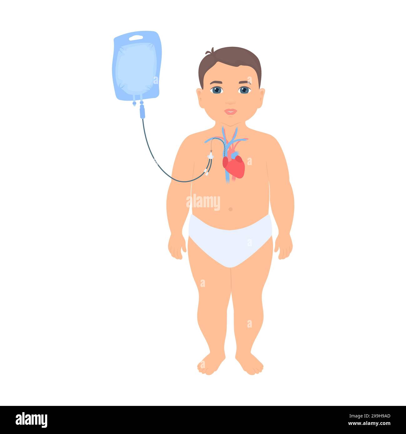 Illustration showing a child receiving parenteral nutrition through a ...