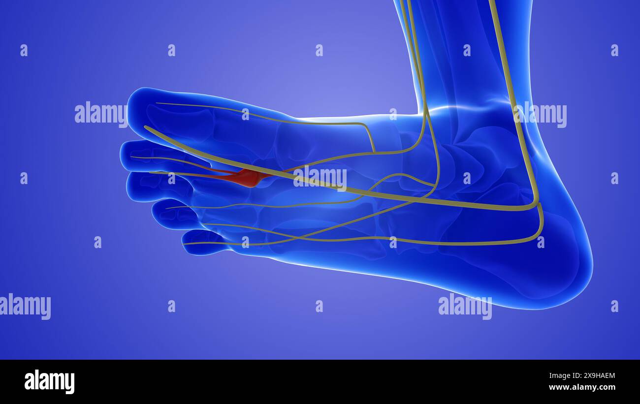 Neuroma painful foot condition or pinched nerve Stock Photo - Alamy