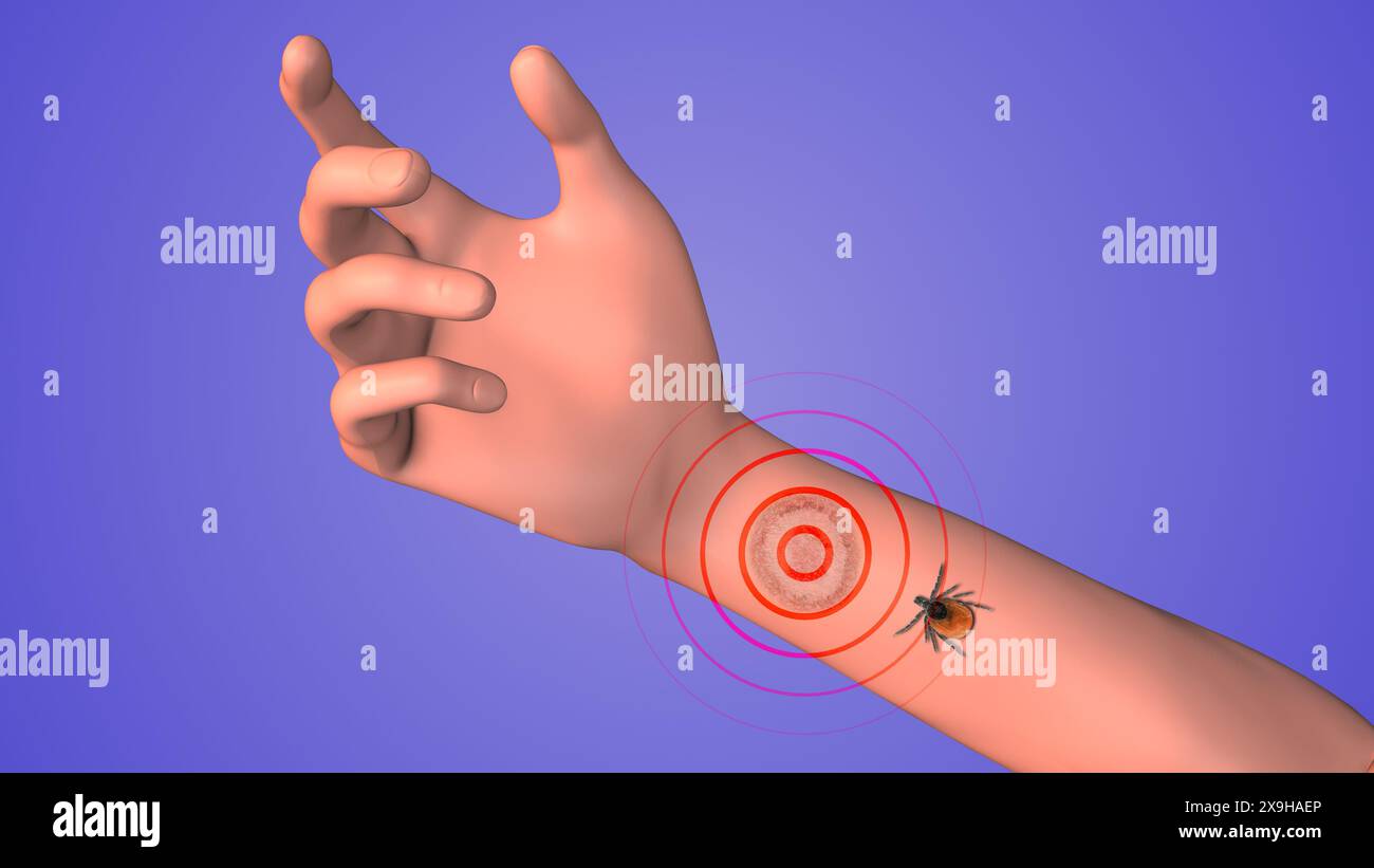 Lyme disease with tick medical concept Stock Photo - Alamy