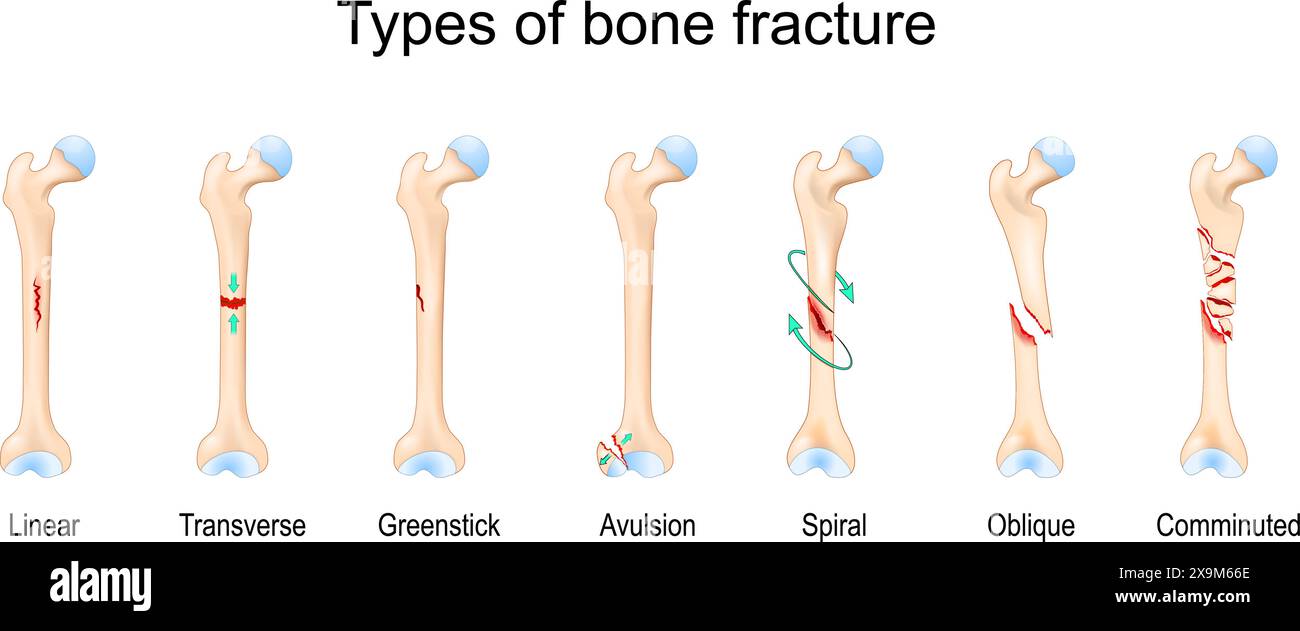 Types Of Bone Fracture Femur Bone Vector Illustration Stock Vector Image And Art Alamy
