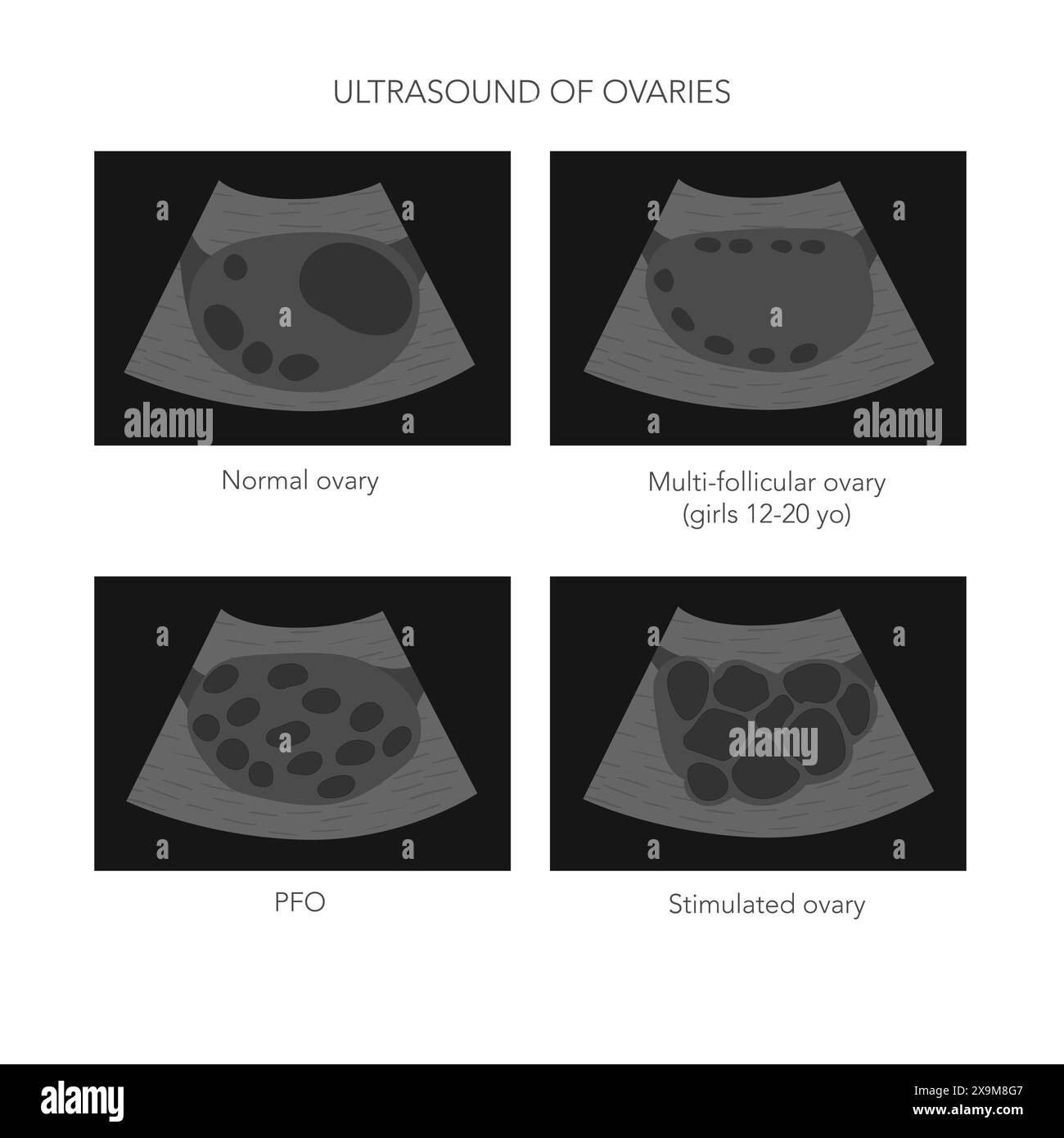 Medical vector illustration of ovaries ultrasound with normal ...