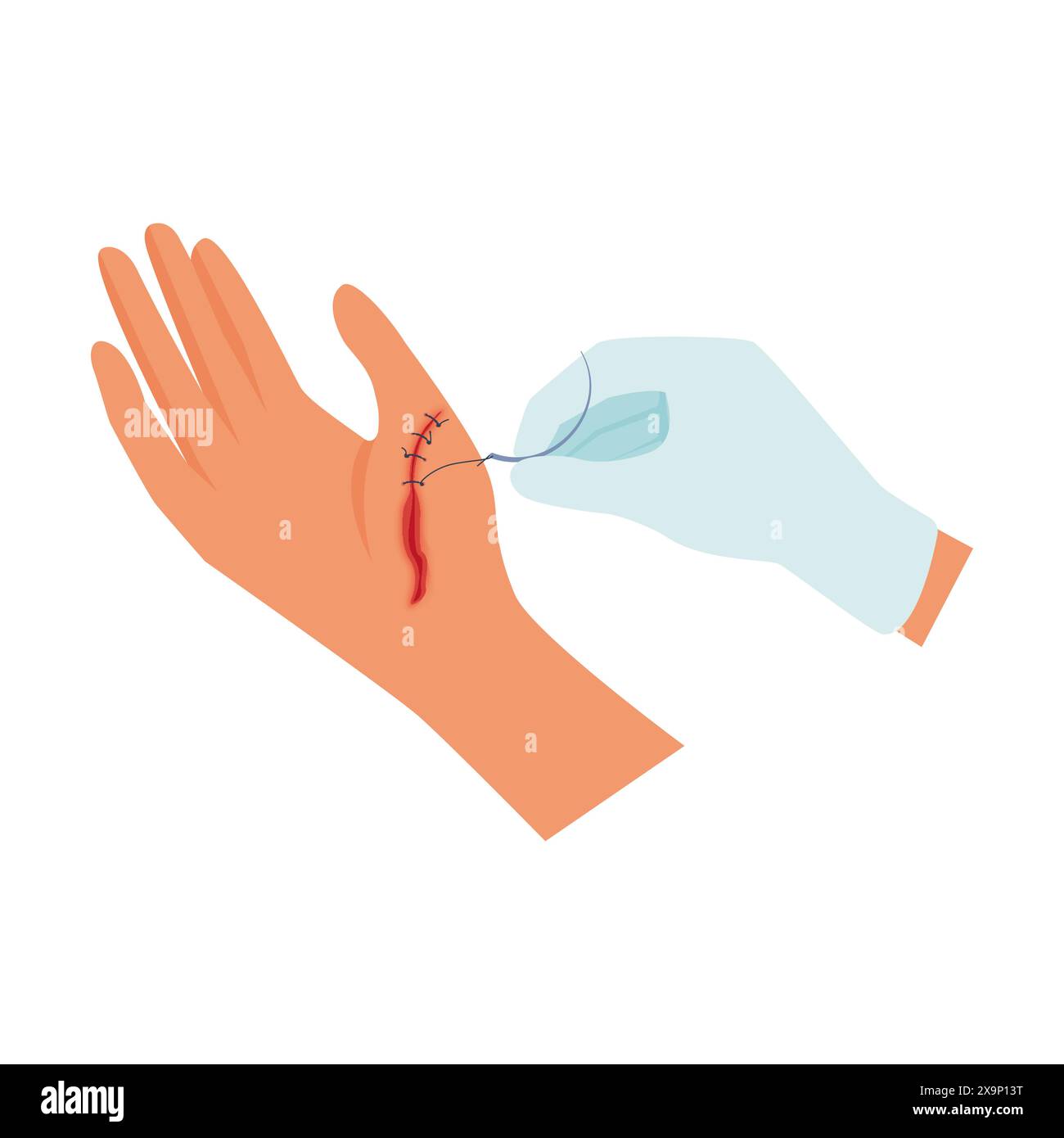 Doctors hand in surgical glove sewing up open wound on patients arm ...