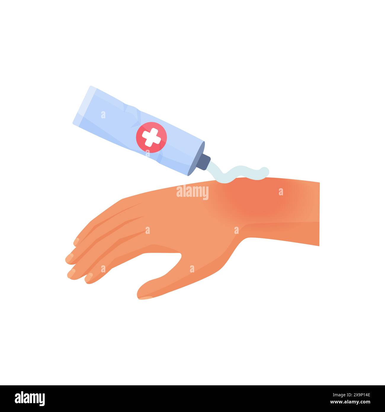 Procedure for applying antibacterial cream to skin of hand with injury ...