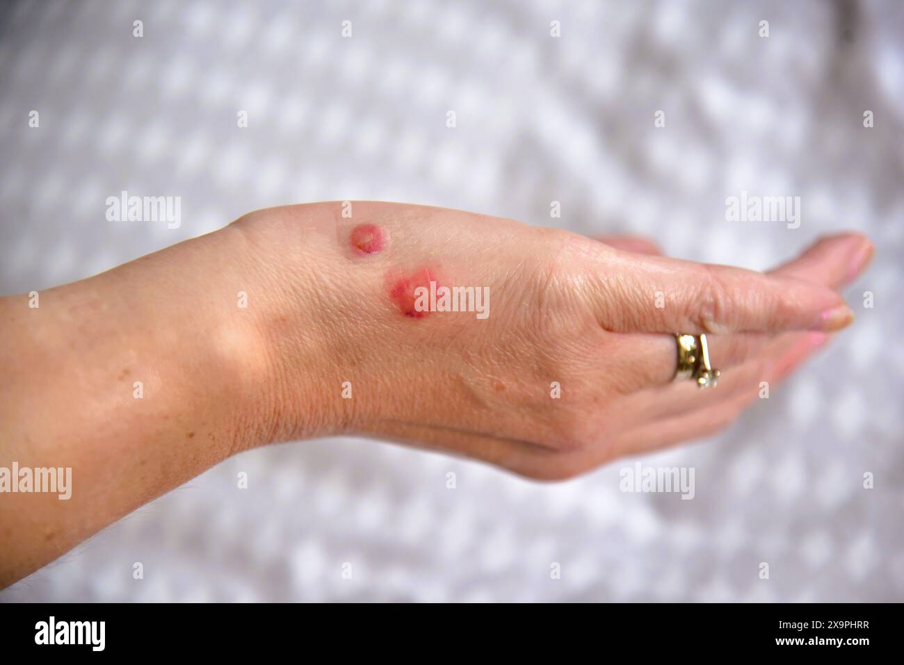Treated with anti histamine tablets hi-res stock photography and images ...