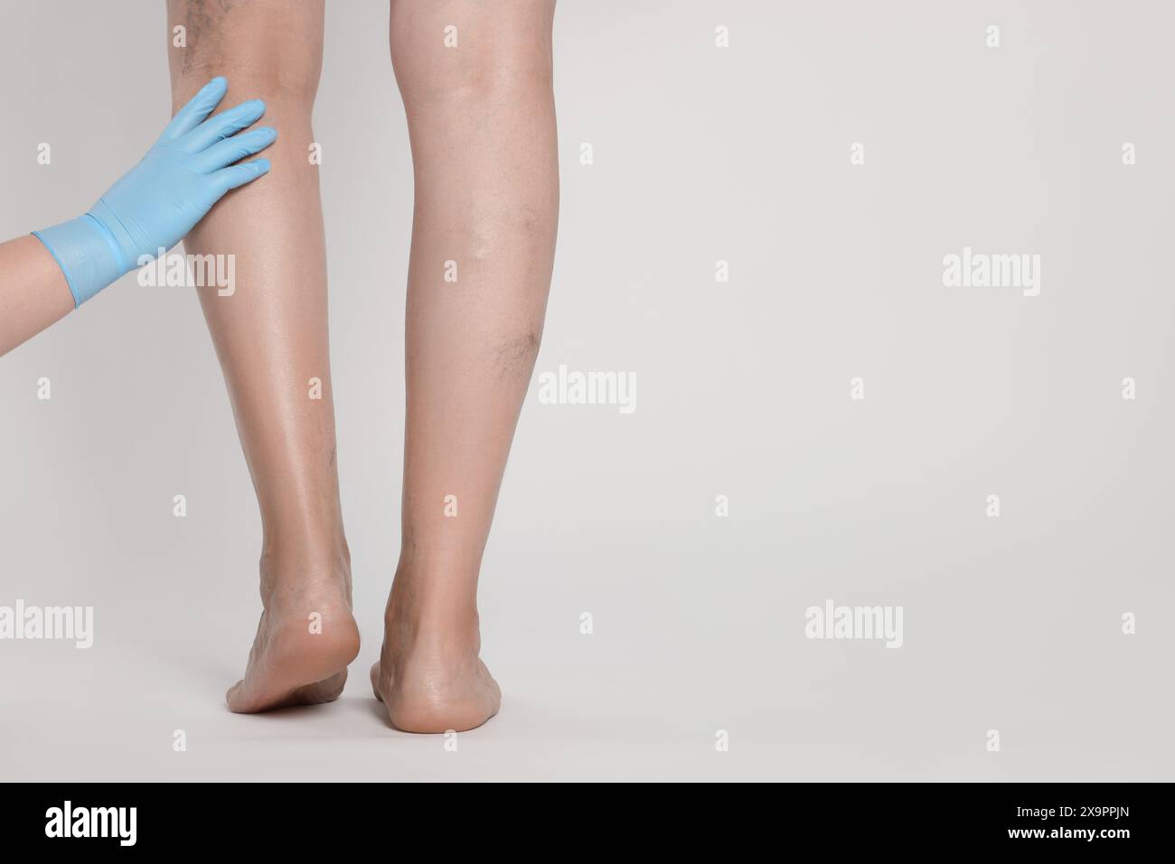 Doctor Examining Patient With Varicose Veins On Light Background