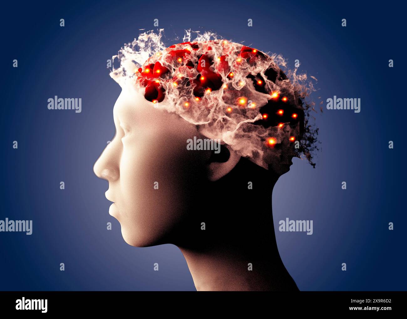 Face seen from the side. Woman, degenerative disease. Brain ...